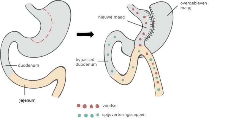 De mini gastric bypass operatie, werkwijze, voor- en nadelen.