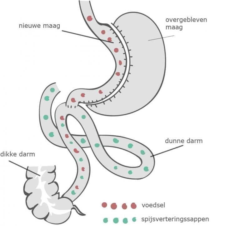 De gastric bypass operatie, werkwijze, voor- en nadelen ...
